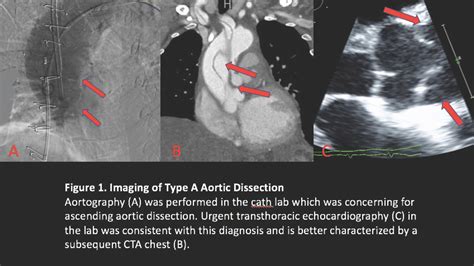 Aortic Dissection After Cardiac Catheterization Jmbe