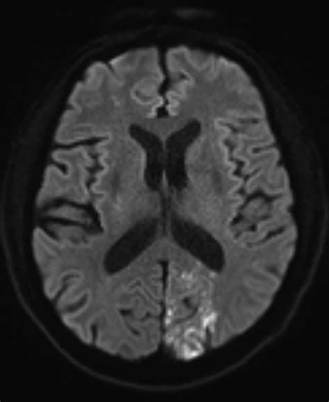Vasculitis On Brain Angiography Is Not Always Vasculitis Intravascular