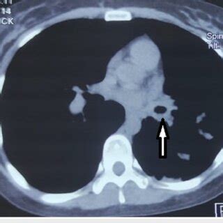 Chest Tomography Axial View Showing Peribronchial Thickening Of The Download Scientific