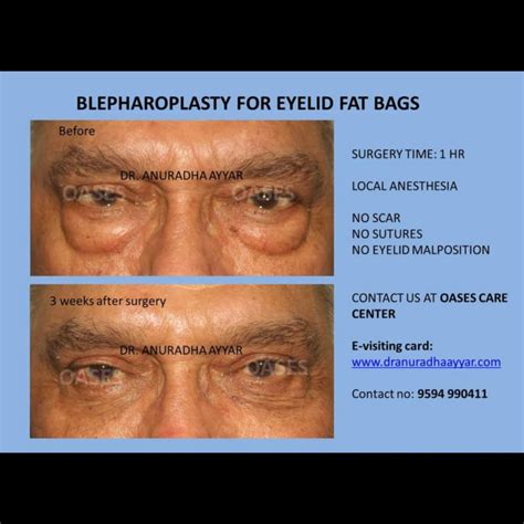 Transconjunctival Scarless Sutureless Eyeplasty Plasticsurgery Cosmeticsurgery