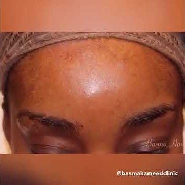 How To Cover Car Accident Scar By Basma Hameed Clinic Youtube