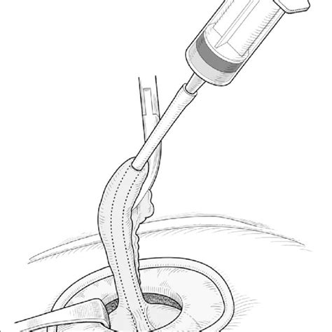 Decompression Of A Dilated Large Bowel The Mobilized Appendix Was