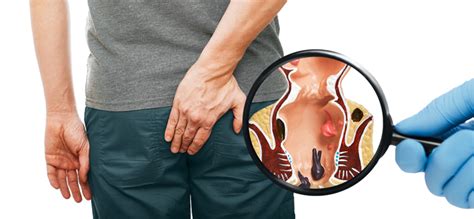 Understanding And Treating Recurring Hemorrhoids Heritage Surgical Group