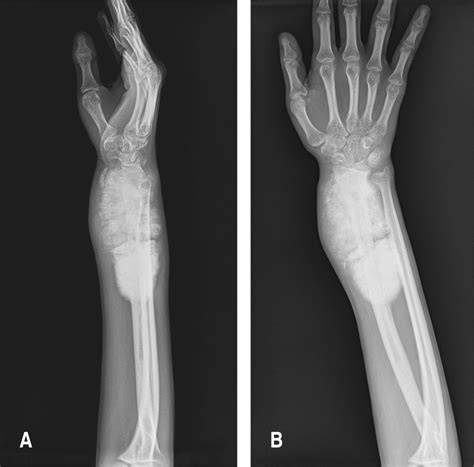 High Grade Distal Radius Osteosarcoma Associated With Retinoblastoma