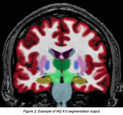 Neuroquant 40 Improved Segmentation Cortechsai