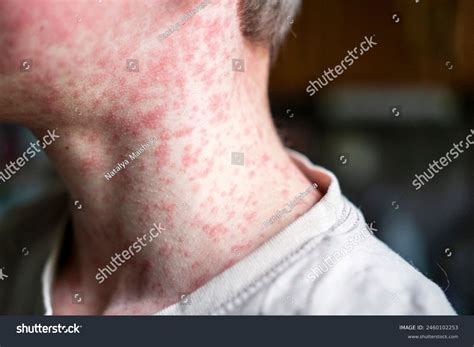 Skin Rash Measles