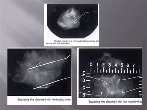 Conservative Breast Surgery Pptx
