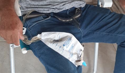 Em Prol Da Cirurgia Rtu De Próstata Com Patologia De Cid N40 Em Uso De