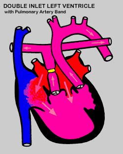 Double Inlet Left Ventricle Congenital Heart Disease Cove Point