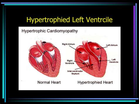 Ppt Cardiac Issues In Friedreichs Ataxia Powerpoint Presentation