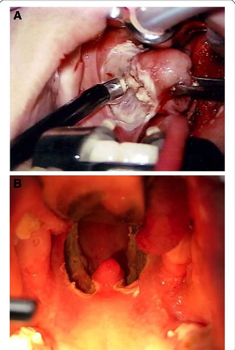 A Intraoperative Image Of Coblation Tonsillectomy B Immediate Download Scientific Diagram