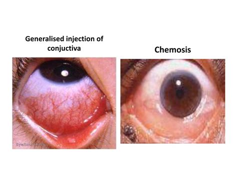 Diseases Of Conjunctiva Pptx