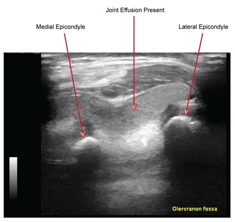 Use Of Pocus For The Paediatric Patient With An Undifferentiated Upper