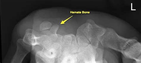 Orthopedic X Rays Masterclass Emergency Medicine Cases