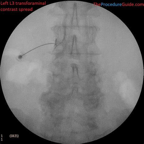 Fluoroscopic Guided Thoraciclumbar Interlaminar Epidural Steroid