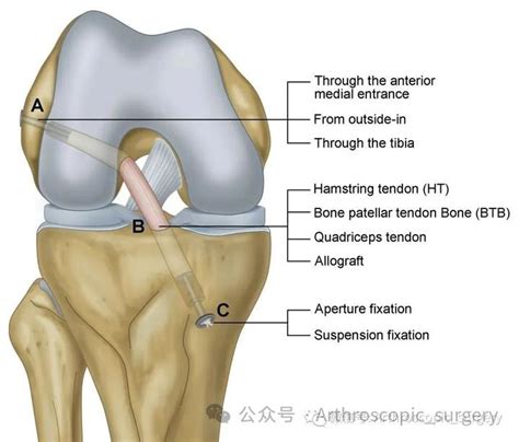 它山之石丨前十字韧带全内重建技术中国专家共识2023年版 知乎