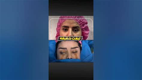 لیفت شقیقه برای خانم پریسا یزدانی که تغییرات رو دیگه خودتون ببنید 💫 Youtube