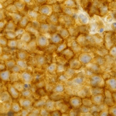 High Magnification Of Malignant Lymphocytes Download Scientific Diagram