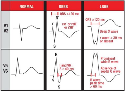The Heart 🔴ecg Rbbb Vs Lbbb⤵️🔹 Cardiology Foamed Meded