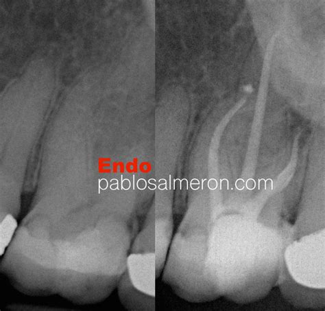First Upper Molar Root Canal Dr Pablo Salmeron Consultant