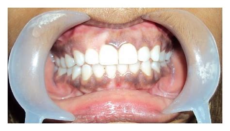 Clinical Presentation Shows White Patch On The Gingiva Download Scientific Diagram