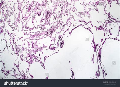 Emphysema Histology Labeled