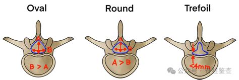 文献查阅丨l5椎管类型影响椎弓根钉置入 脑医汇