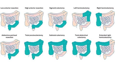 Colon Bleeding Approach And Investigations Ppt
