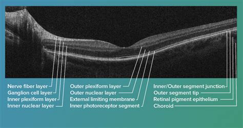 Oct In Ophthalmology Wasatch Photonics