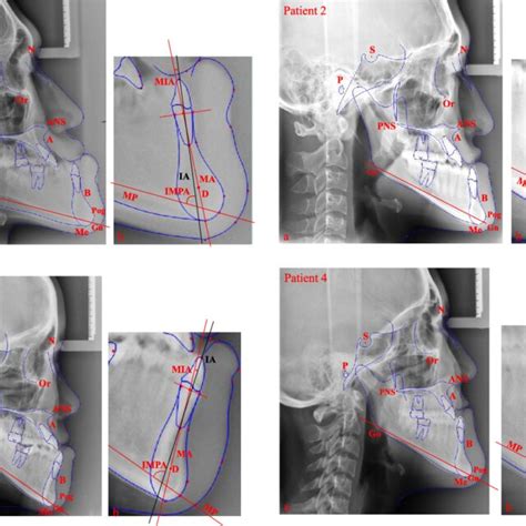 Examples Of Cephalometric Digitization In Severe Skeletal Class Iii