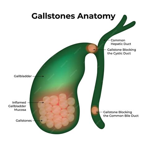 Premium Vector Gallstones Anatomy Gallbladder Hepatic Duct Mucosa