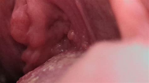 Lump Near Tonsil And Freaking Out Because It Hurts And Have Ear Pain