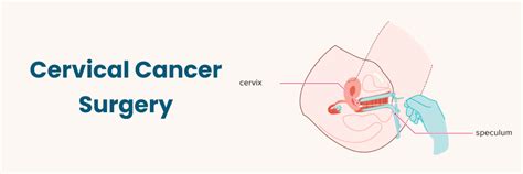 Cervical Cancer Surgery Types Pre Surgery Preparation