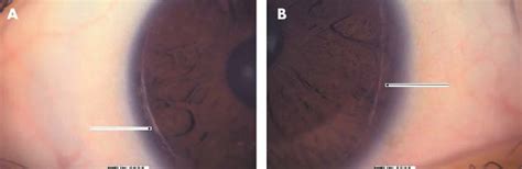A Thickened Schwalbes Line Arrowed Indicative Of Posterior