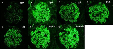 Management And Treatment Of Lupus Nephritis Ajkd Blog