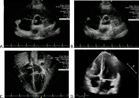 Echocardiogram Abnormalities For Patient 1 A B And Patient 2 C D