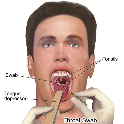 An Insight Into Strep Throat Symptoms and Measures to Treat