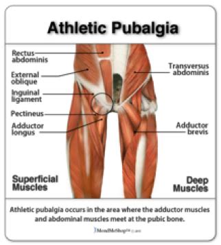 Sports Hernia Athletic Pubalgia Orthoinfo Aaos
