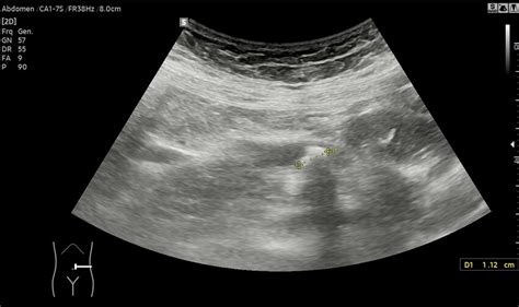 Radiopaedia Case Obstructive Ureterolithiasis Ultrasound Id 96314