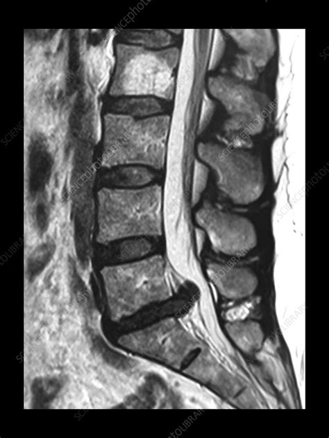 Lumbar Disc Herniation X Ray At Callum Fowler Blog