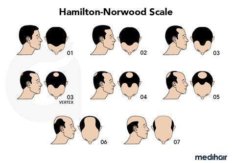 Crown Hair Transplant Cost Before And After And Best Clinics