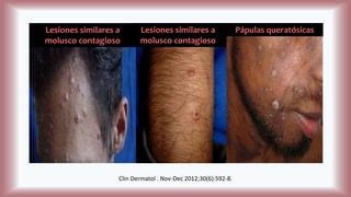 Copia De Histoplasmosis 220803011923 838ad95e Pptx