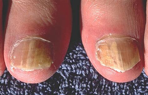 Onicomicosis Wikipedia La Enciclopedia Libre