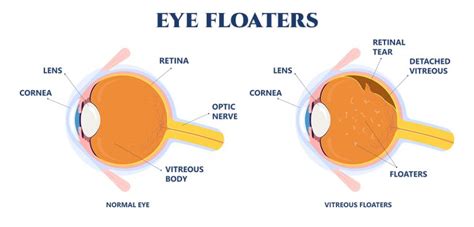 Eye Floaters South Carolina Retina Institute