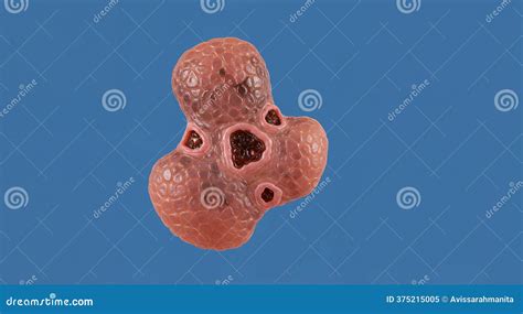 Malignant Melanoma Skin Disease Skin Cancer Cartoon Vector