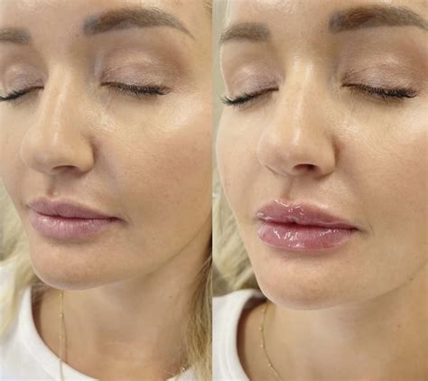 Innerbeauty Med Spa Gallery Injections Hair Removal Body Contouring