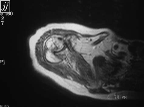 Msk Shoulder Joint Dislocation And Fracture And Shoulder Griddle