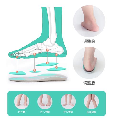 定制矫正鞋垫真的是智商税吗？ 知乎