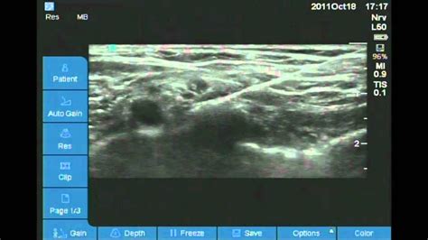 Supraclavicular Block