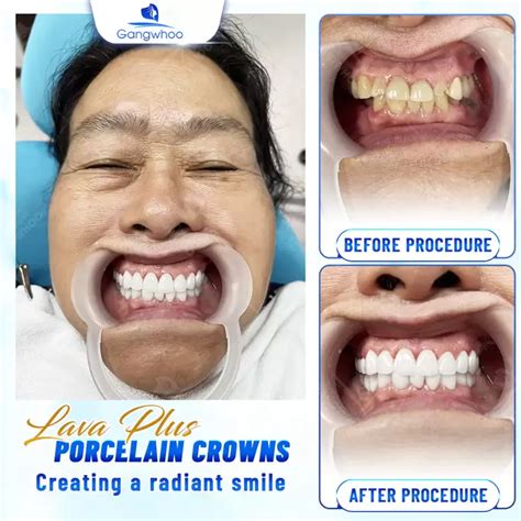 Porcelain Crown For A Smile Youve Ever Wanted Gangwhoo Cosmetic Hospital Plastic Surgery